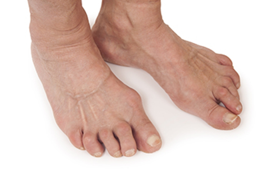 Foot Joint Pain and Other Signs of Rheumatoid Arthritis